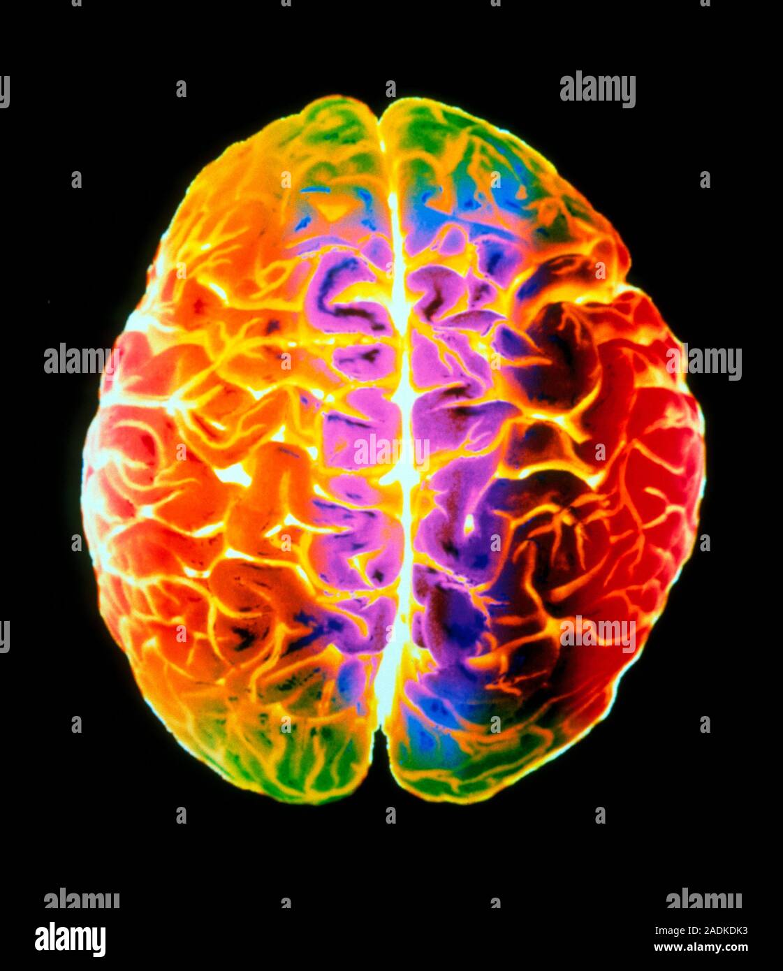 3D-MRT-Scan des Gehirns. Farbige dreidimensionalen Magnetresonanztomographie (MRT) Scan eines ...