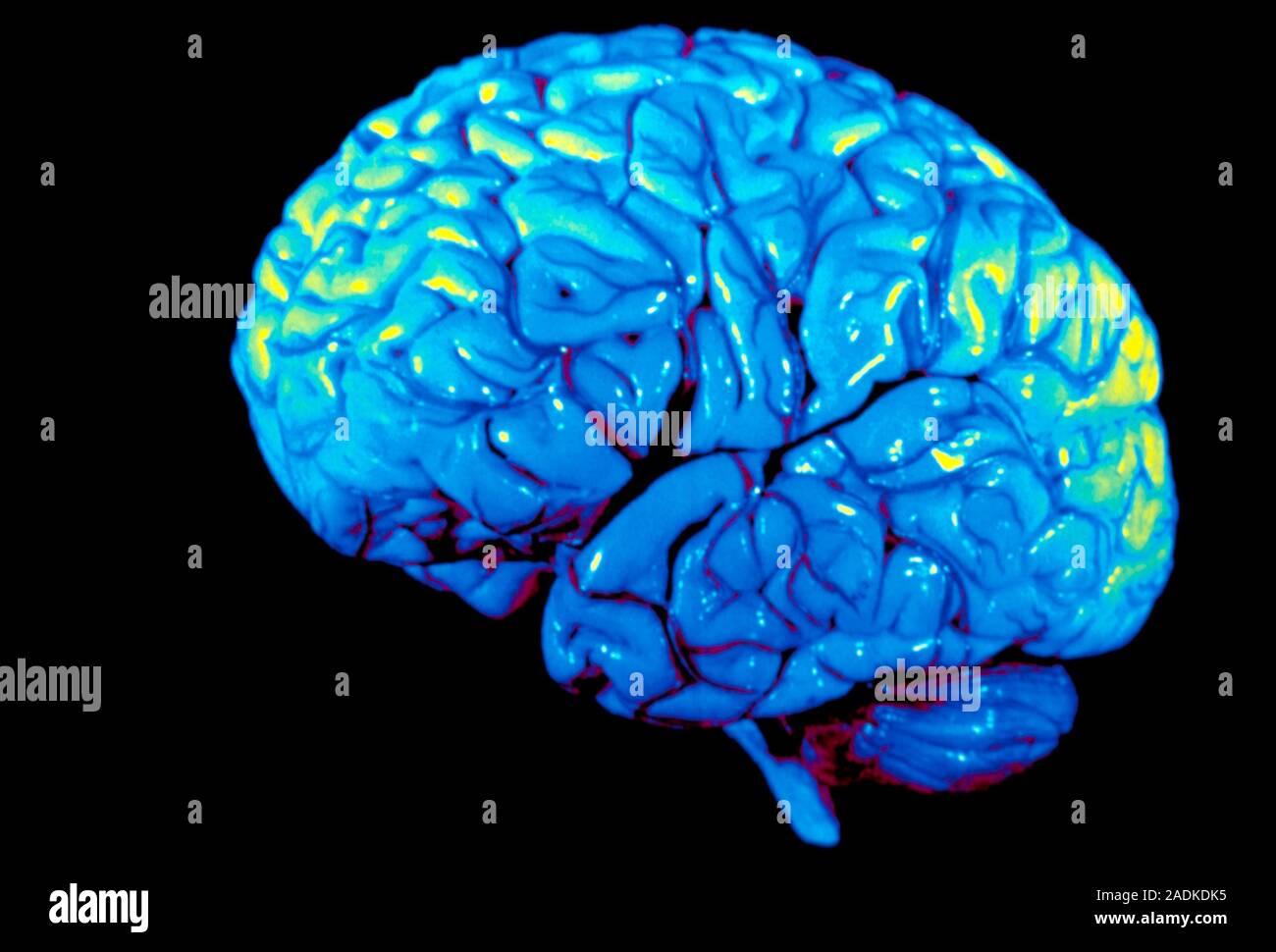 3D-MRT-Scan des Gehirns. Farbige dreidimensionalen Magnetresonanztomographie (MRT) Scan eines ...