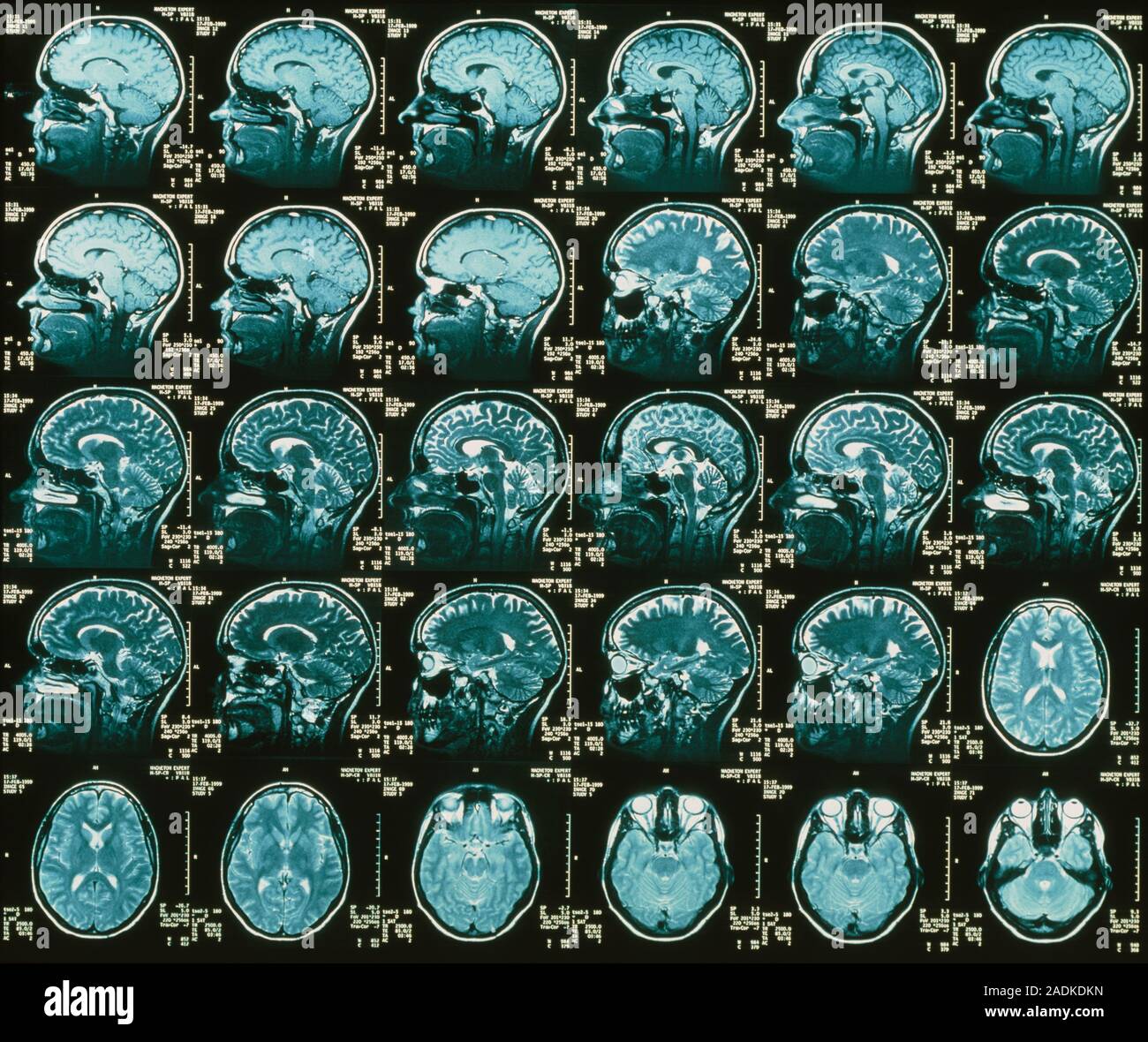 Scans des Gehirns. Die Magnetresonanztomographie (MRT) Scans durch einen menschlichen Kopf, ein ...