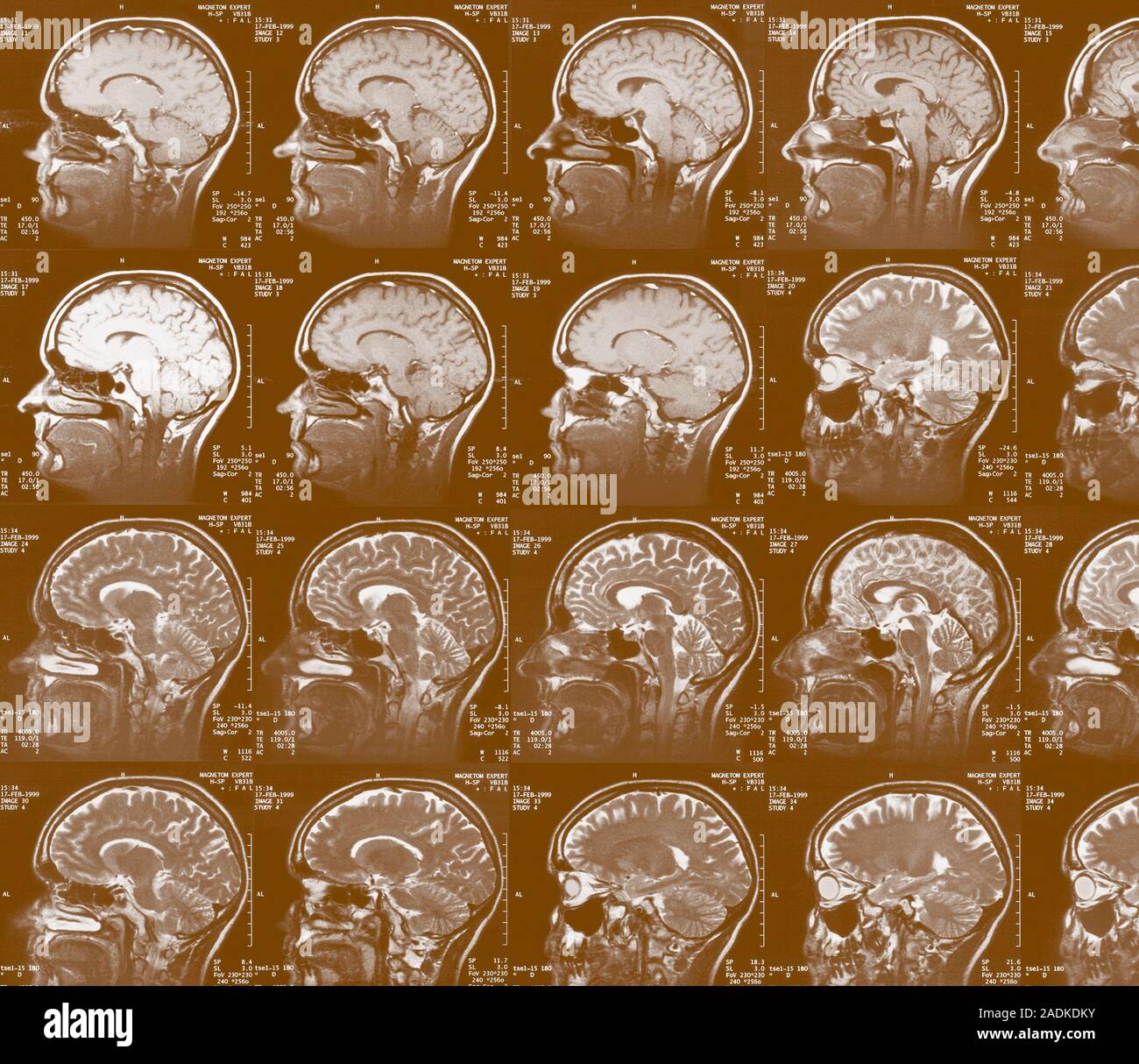 Scans des Gehirns. Farbige Magnetresonanztomographie (MRT) Scans durch einen menschlichen Kopf ...