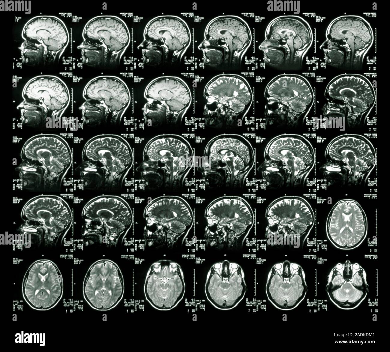 Scans des Gehirns. Die Magnetresonanztomographie (MRT) Scans durch einen menschlichen Kopf, ein ...