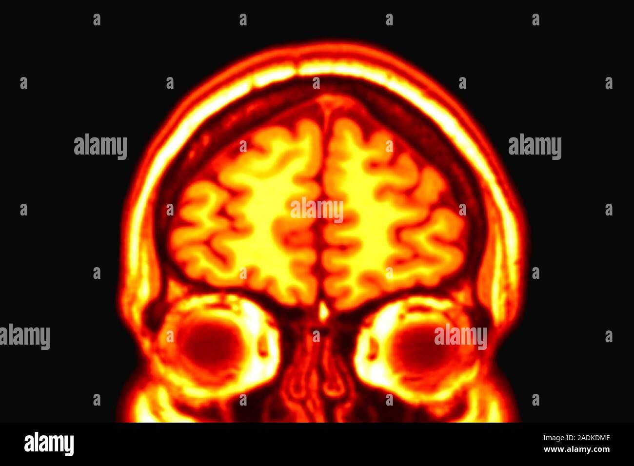 Gehirn-scan. Farbige Magnetresonanztomographie (MRT) Scan eines koronalen (frontal) Schnitt ...