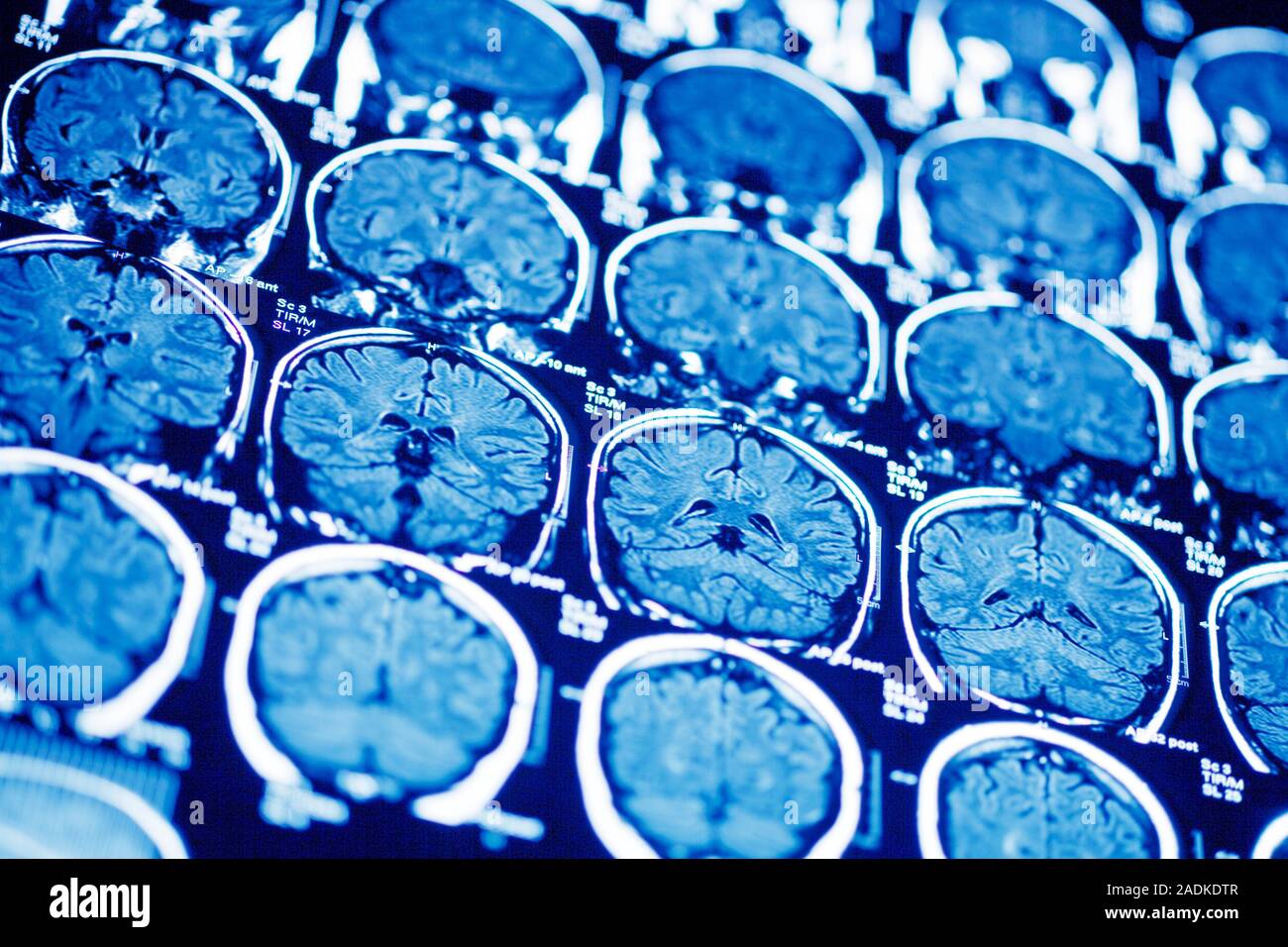 Scans des Gehirns. Die Magnetresonanztomographie (MRT) Scans von einem gesunden Gehirn. Diese ...