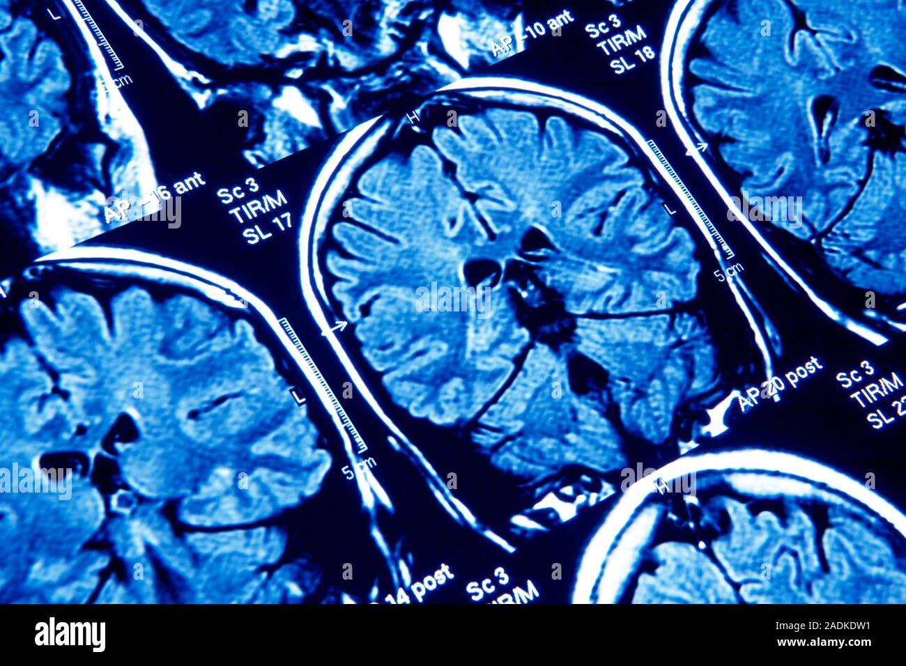 Scans des Gehirns. Die Magnetresonanztomographie (MRT) Scans von einem gesunden Gehirn. Diese ...