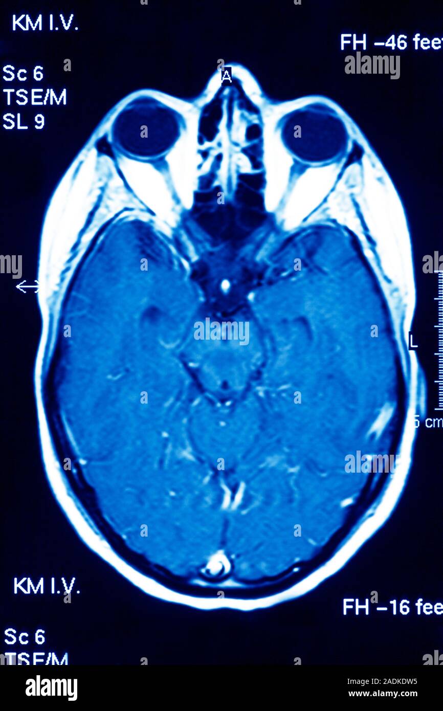 Gehirn-scan. Farbige Magnetresonanztomographie (MRT) Scan eines axialen (horizontal) Schnitt ...