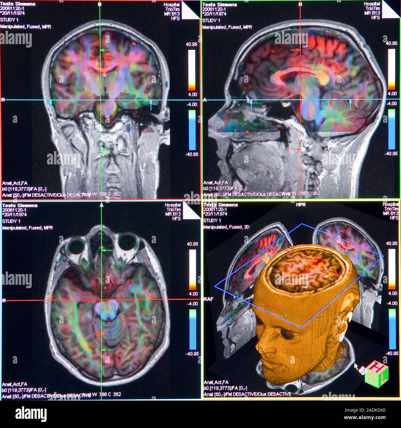 Fortgeschrittene MRT-Scans des Gehirns. Die Magnetresonanztomographie (MRT) Scans von einem ...