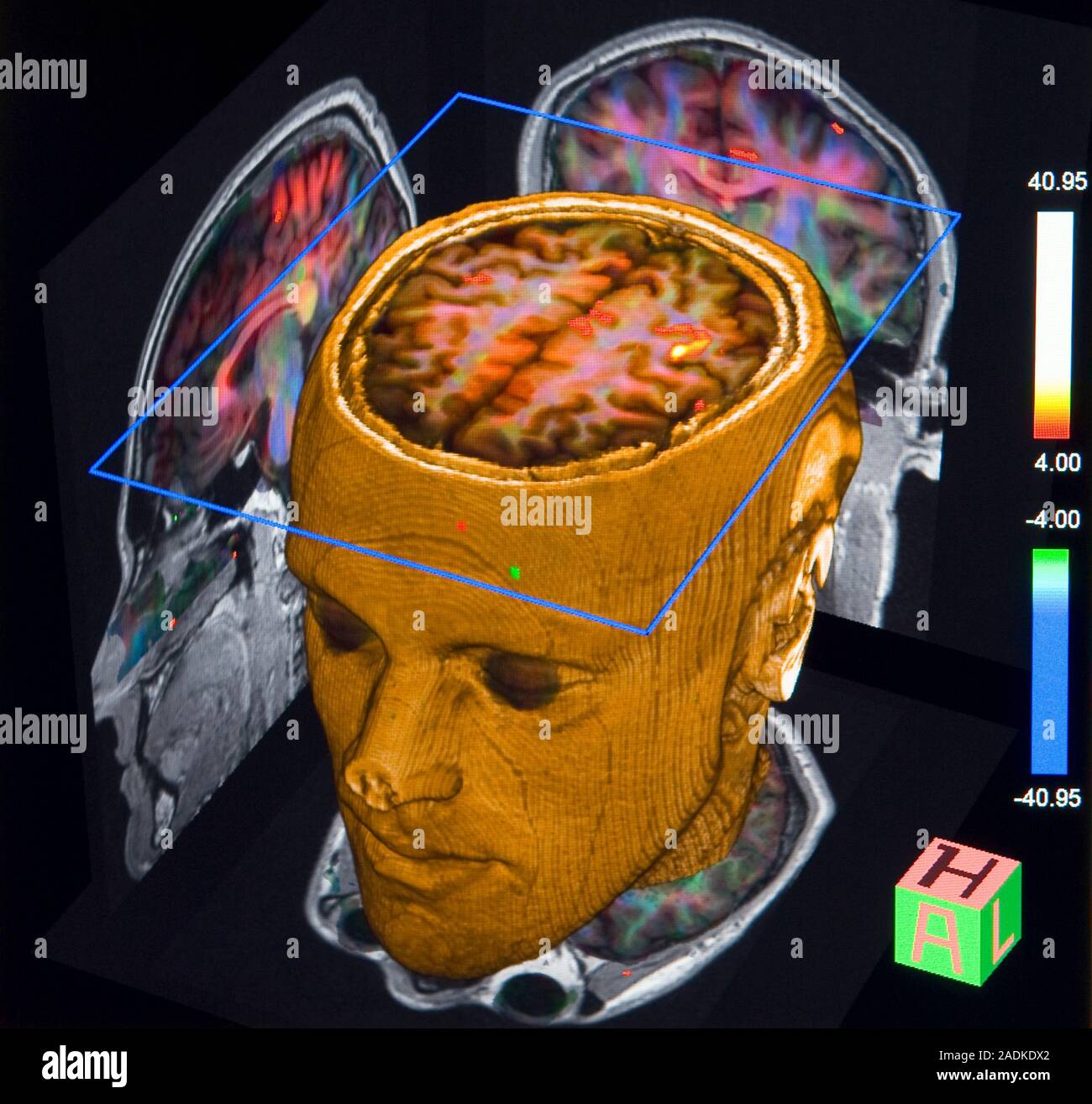 Fortgeschrittene MRT-Scans des Gehirns. Die Magnetresonanztomographie (MRT) Scans von einem ...