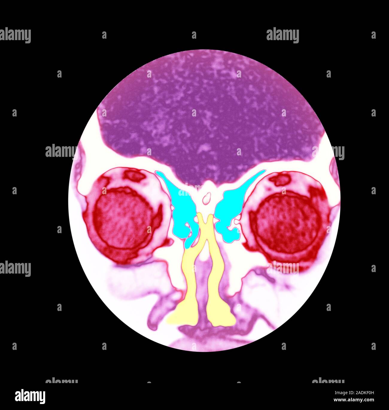 Anatomie der Nase und Nasennebenhöhlen. Farbige Computertomographie (CT ...