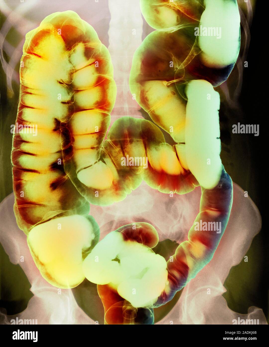 Gesunder Dickdarm, farbige doppelter Kontrastbarium Enema X-ray. Der ...