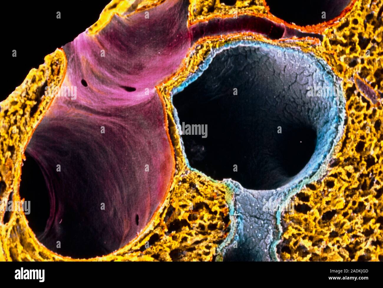 Lunge Lungenbläschen und bronchus. Farbige Scanning Electron Micrograph ...