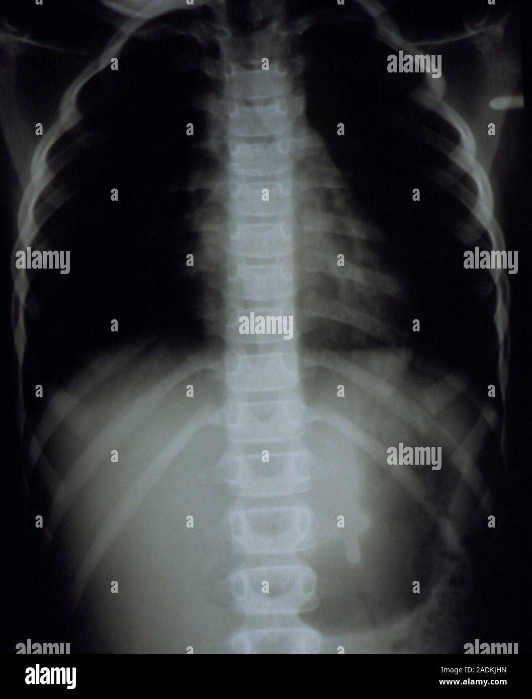 Gesunde Lunge. X-ray von der Brust eines Kindes, zeigt normale Lunge ...