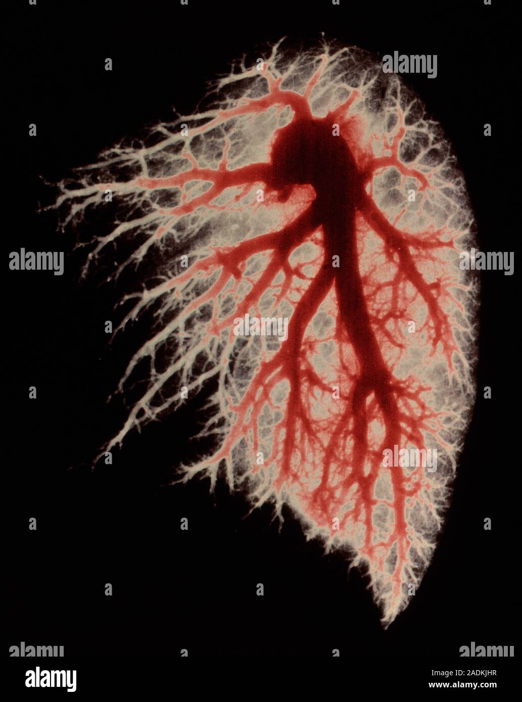 Lungenarterien. Farbige Angiogramm (X-ray oder Angiogramm) Der ...