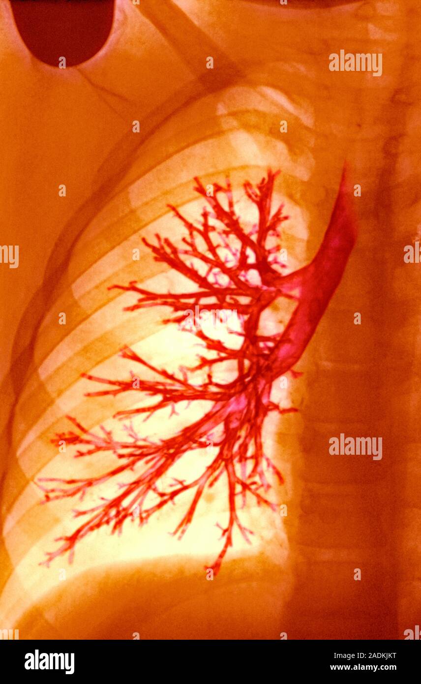 Lunge Bronchiolen. Farbige X-ray des Bronchialbaumes (rot) einer ...