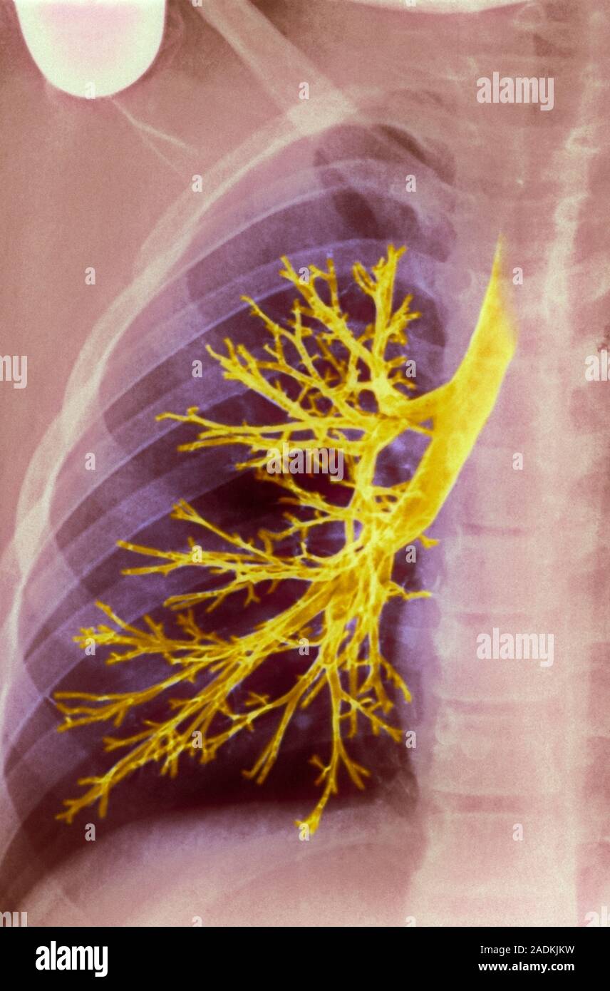 Lunge Bronchiolen. Farbige X-ray des Bronchialbaumes (Gelb) von einer ...