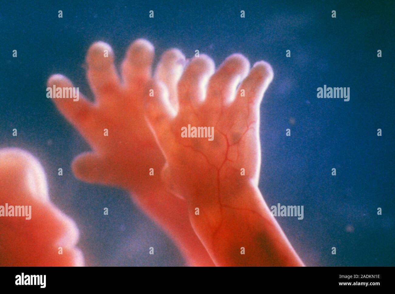 Der menschliche Fetus nach 5 Monaten (22 Wochen) mit dem Grad der ...