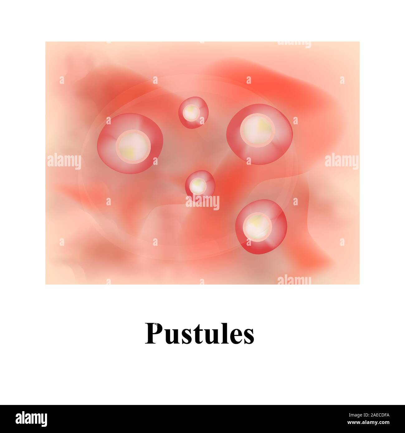 Milium im gesicht -Fotos und -Bildmaterial in hoher Auflösung – Alamy