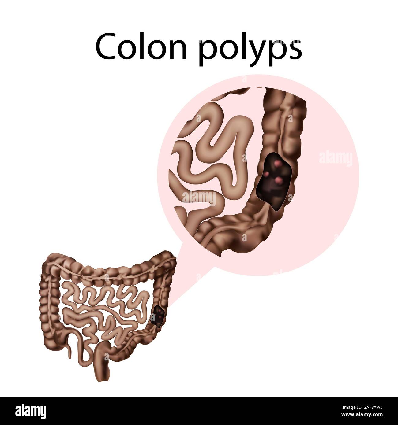 Menschlicher dickdarmpolyp -Fotos und -Bildmaterial in hoher Auflösung ...