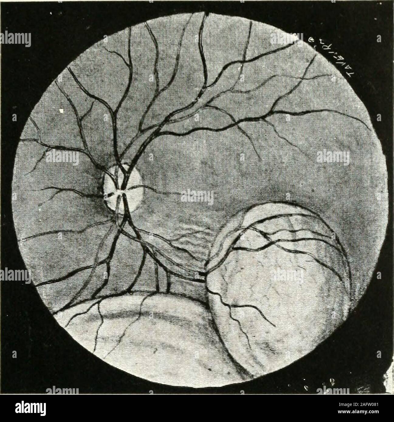 . Oftalmología; estadística [1.]-3. ser. Abb. i .. O.D. Coroiditis ...