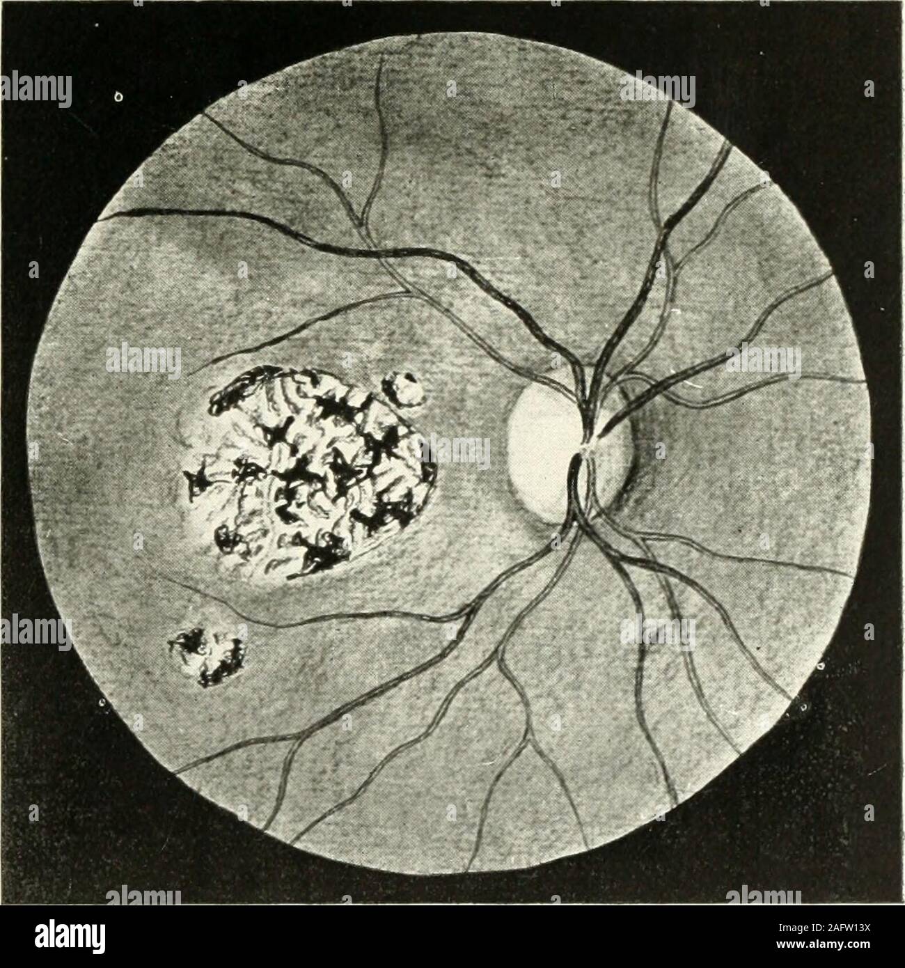 . Oftalmología; estadística [1.]-3. ser. Abb. A.-o. D. Coroiditis ...