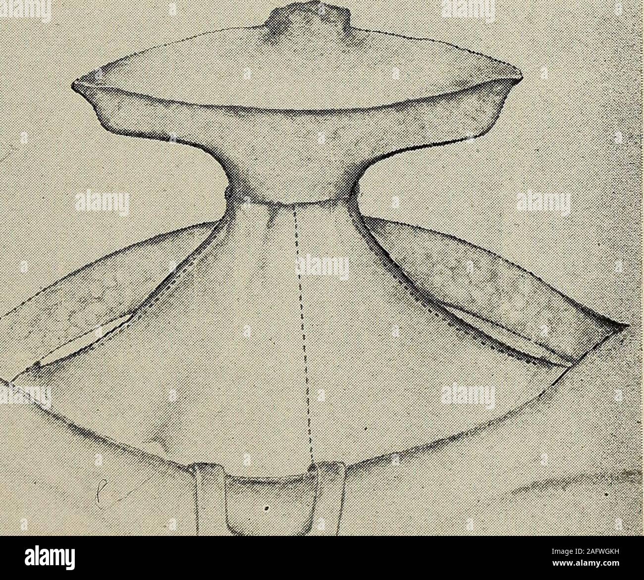 . Transaktionen der westlichen Surgical Association. Abb. 3. Extreme ...