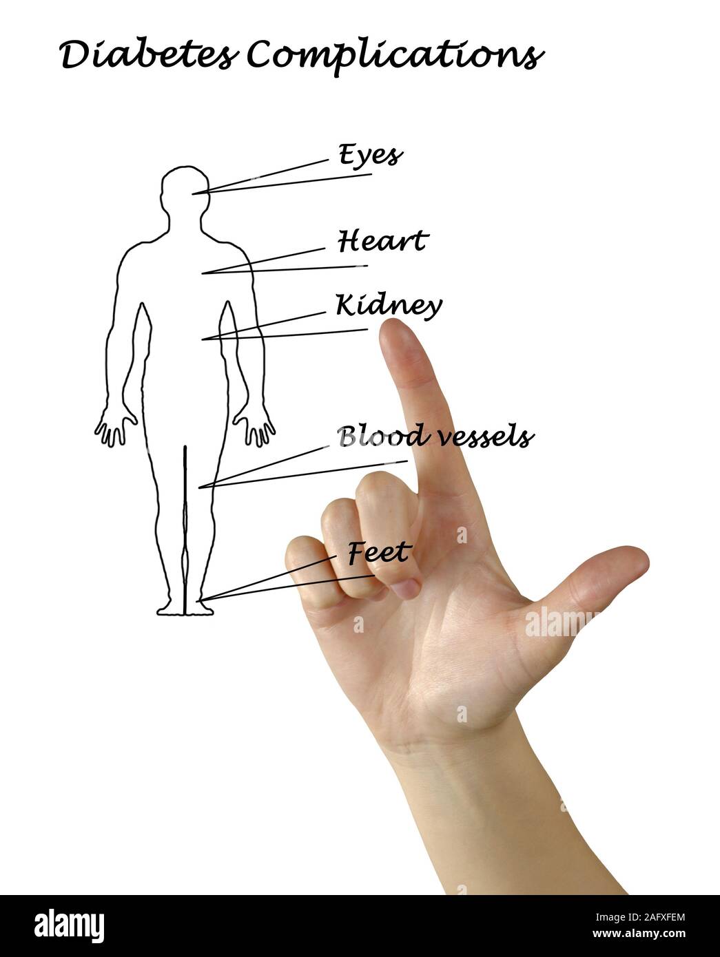 Komplikation des diabetes -Fotos und -Bildmaterial in hoher Auflösung ...