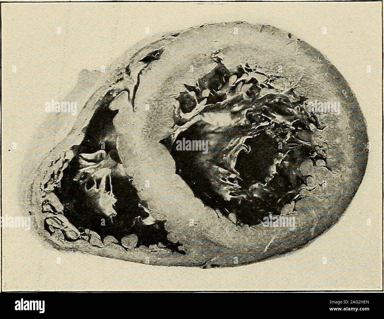 Prophylaxe mit arteriosklerose -Fotos und -Bildmaterial in hoher ...