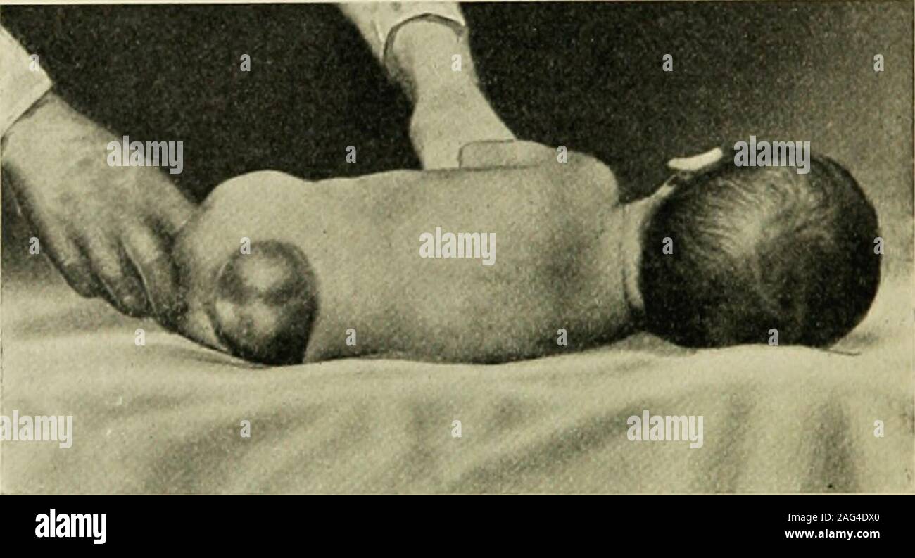 . Die Praxis der Kinderheilkunde. Abb. 62.- Microcephalic Idiot. 484 ...