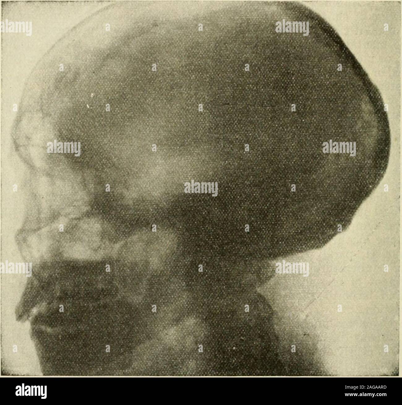 . Die moderne Chirurgie, allgemeine und operative. nic Meningitis von ...