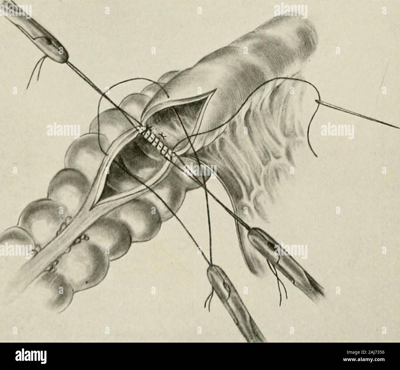 Side to side anastomosis -Fotos und -Bildmaterial in hoher Auflösung ...