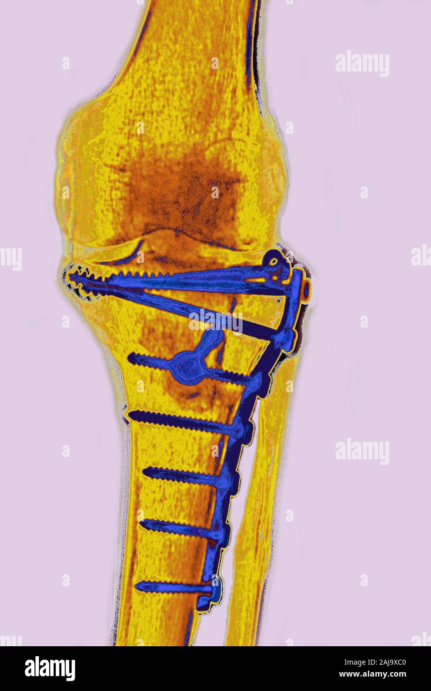 Tibial fracture -Fotos und -Bildmaterial in hoher Auflösung – Alamy