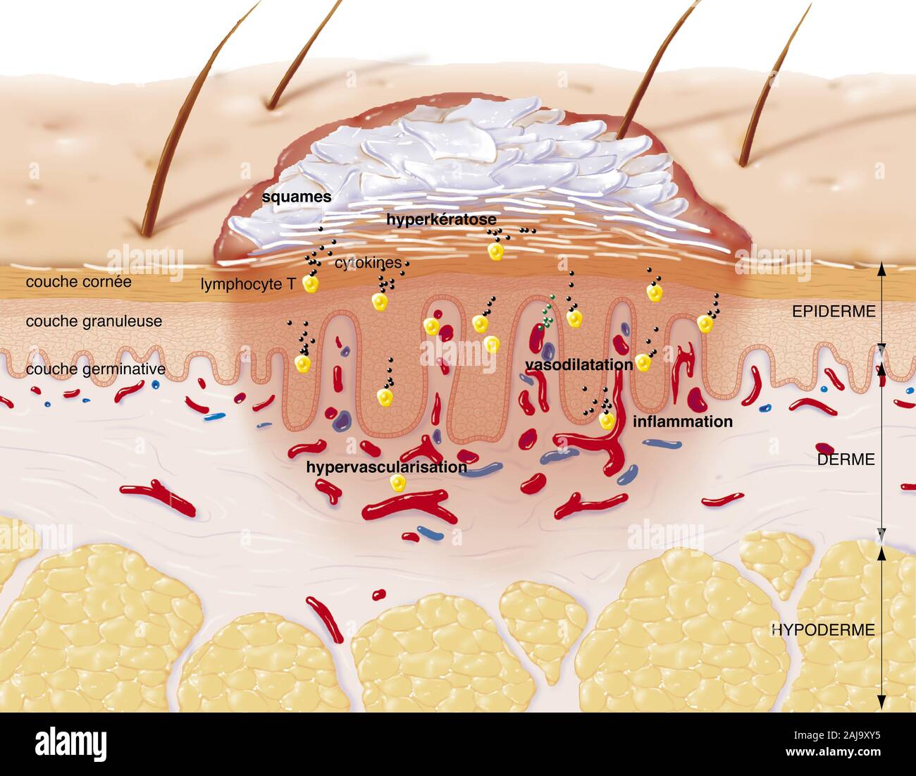 Psoriasis in Abschnitt, erythematöser - squamous Plakette ...