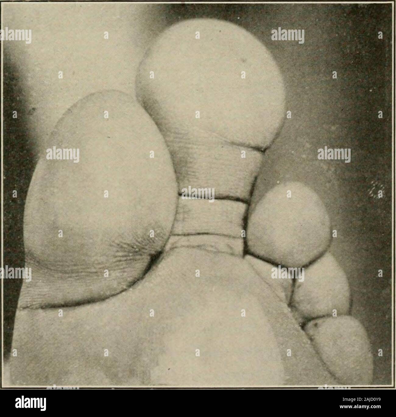 Lipoma fuss -Fotos und -Bildmaterial in hoher Auflösung – Alamy