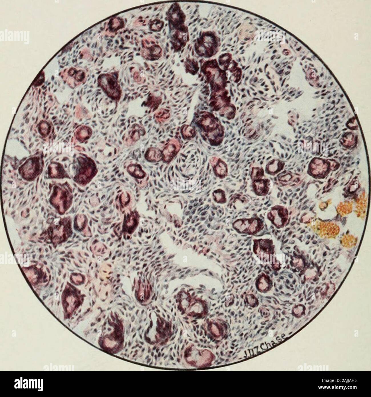 Postoperative komplikation -Fotos und -Bildmaterial in hoher Auflösung ...