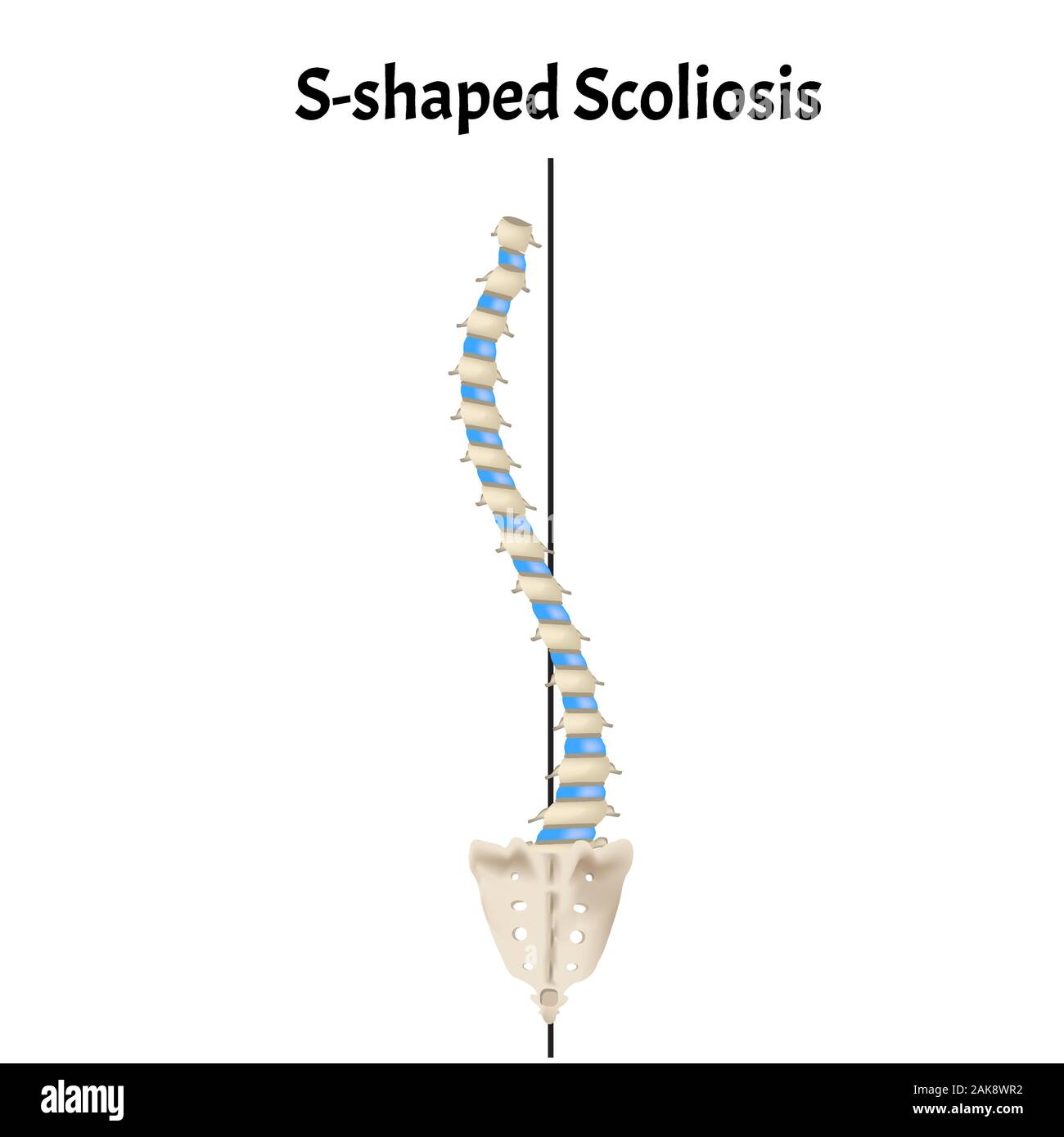 S-förmige Skoliose. Dextroscoliosis. Levoscoliosis. Krümmung der ...