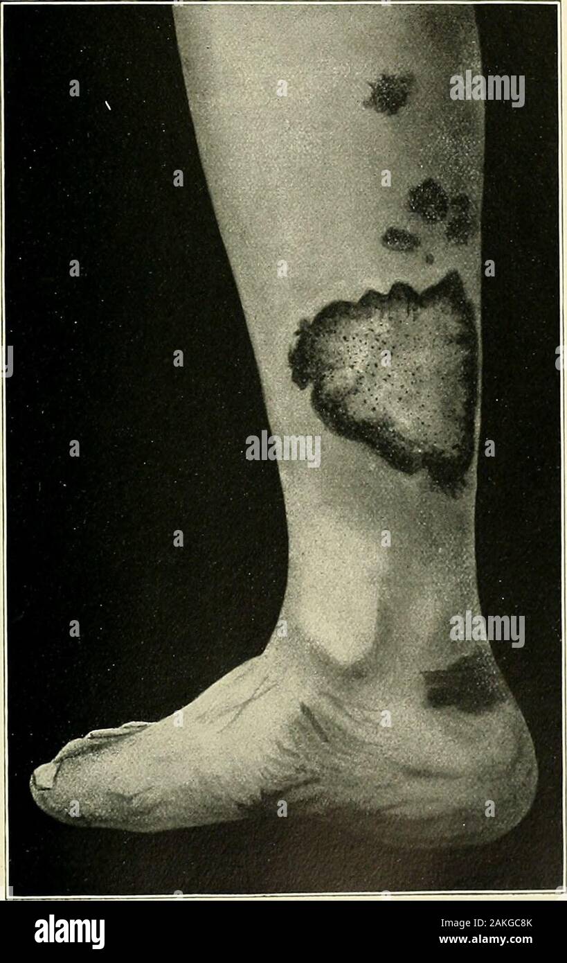 Lepra ulceration -Fotos und -Bildmaterial in hoher Auflösung – Alamy