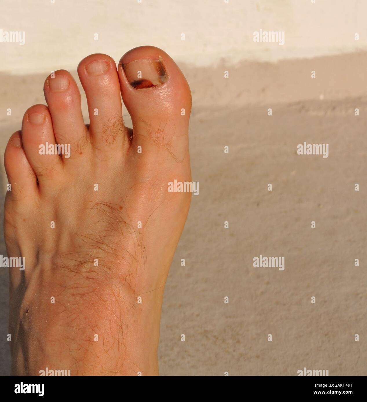 Verletzte Zehe Stockfotos und -bilder Kaufen - Alamy