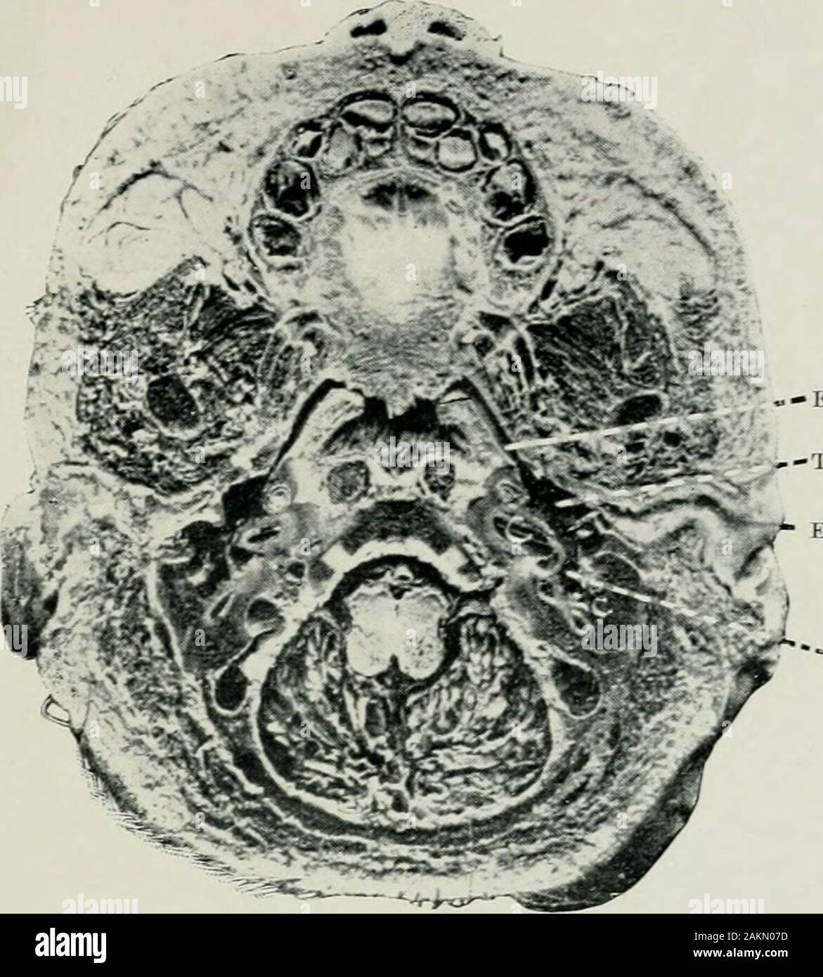 Mastoides antrum -Fotos und -Bildmaterial in hoher Auflösung – Alamy
