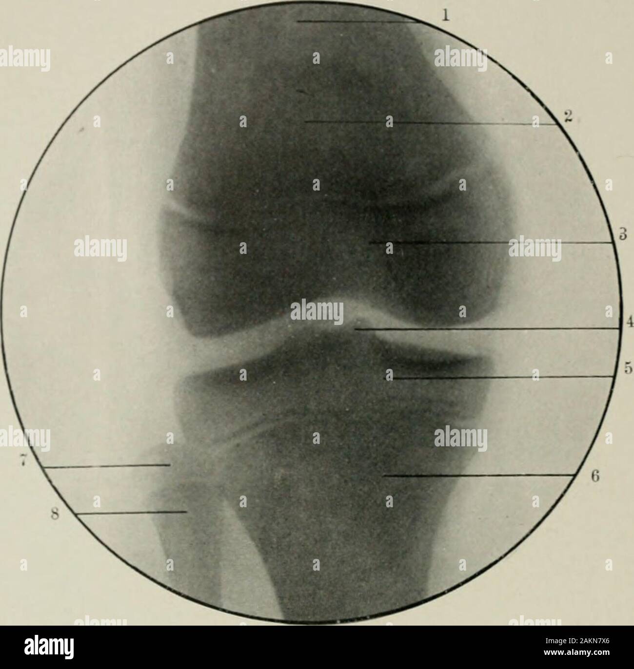 Epiphyseal line -Fotos und -Bildmaterial in hoher Auflösung – Alamy