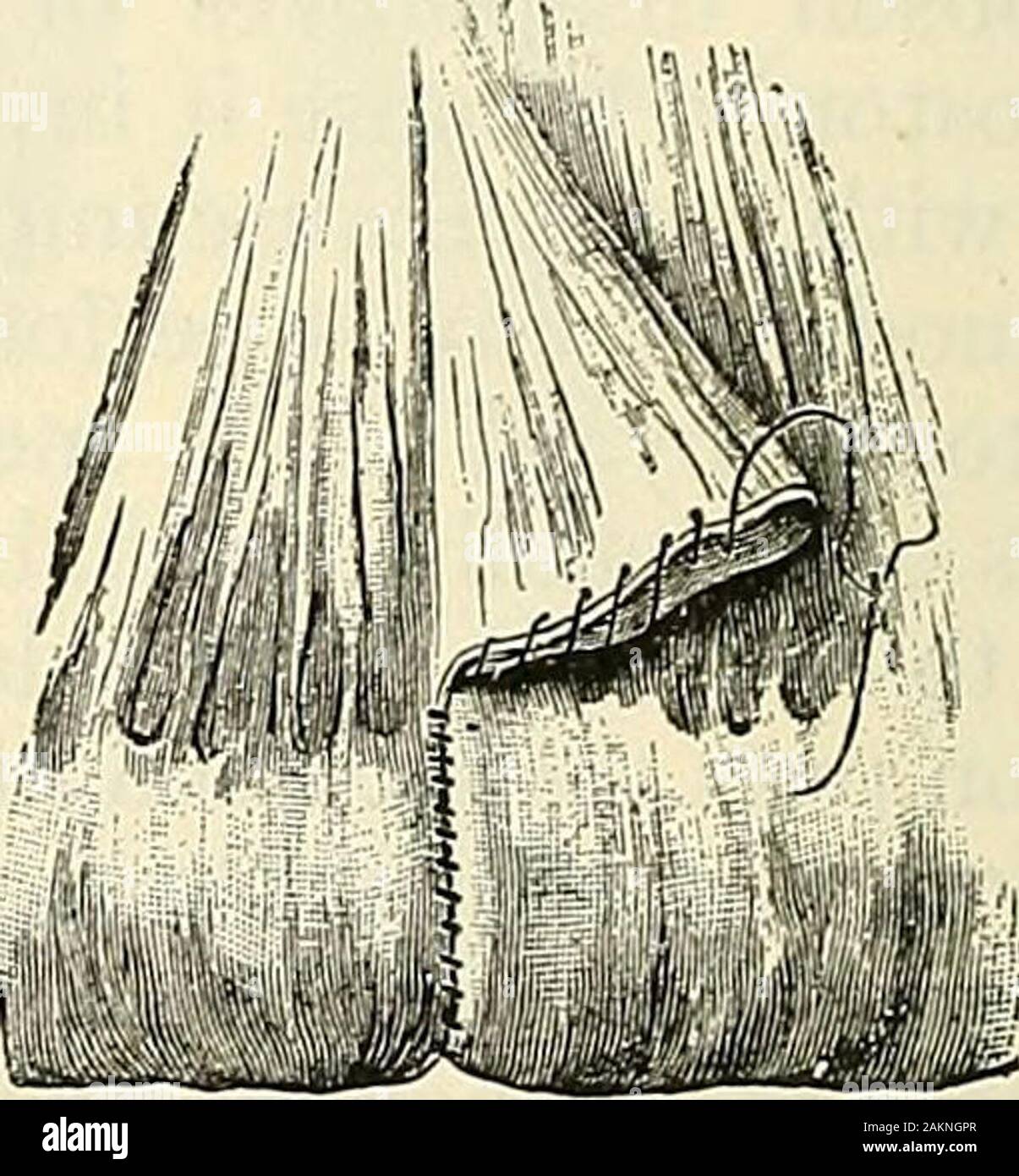 Die moderne Chirurgie, allgemeine und operativen. Abb. 686.- Exzision ...