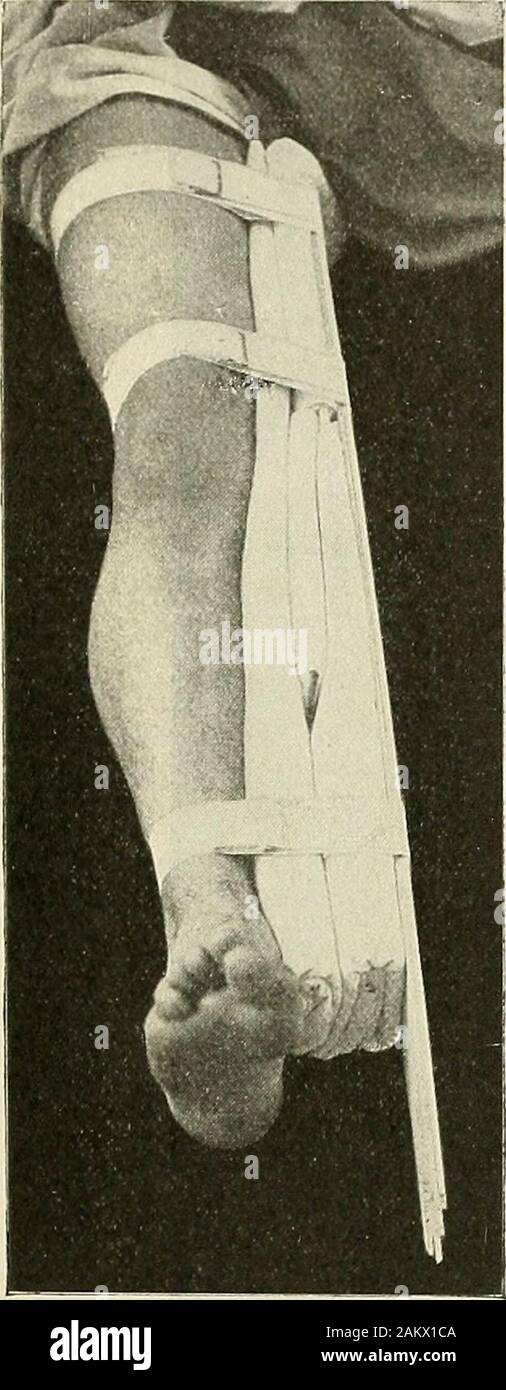 Die moderne Chirurgie, allgemeine und operative. bduction. Wenn eversion ist der alleinige oder ...