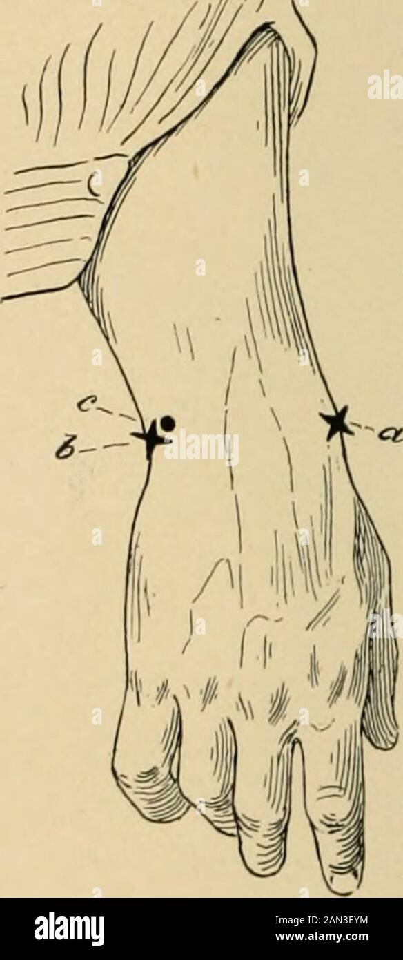 Processus styloideus der ulna -Fotos und -Bildmaterial in hoher ...