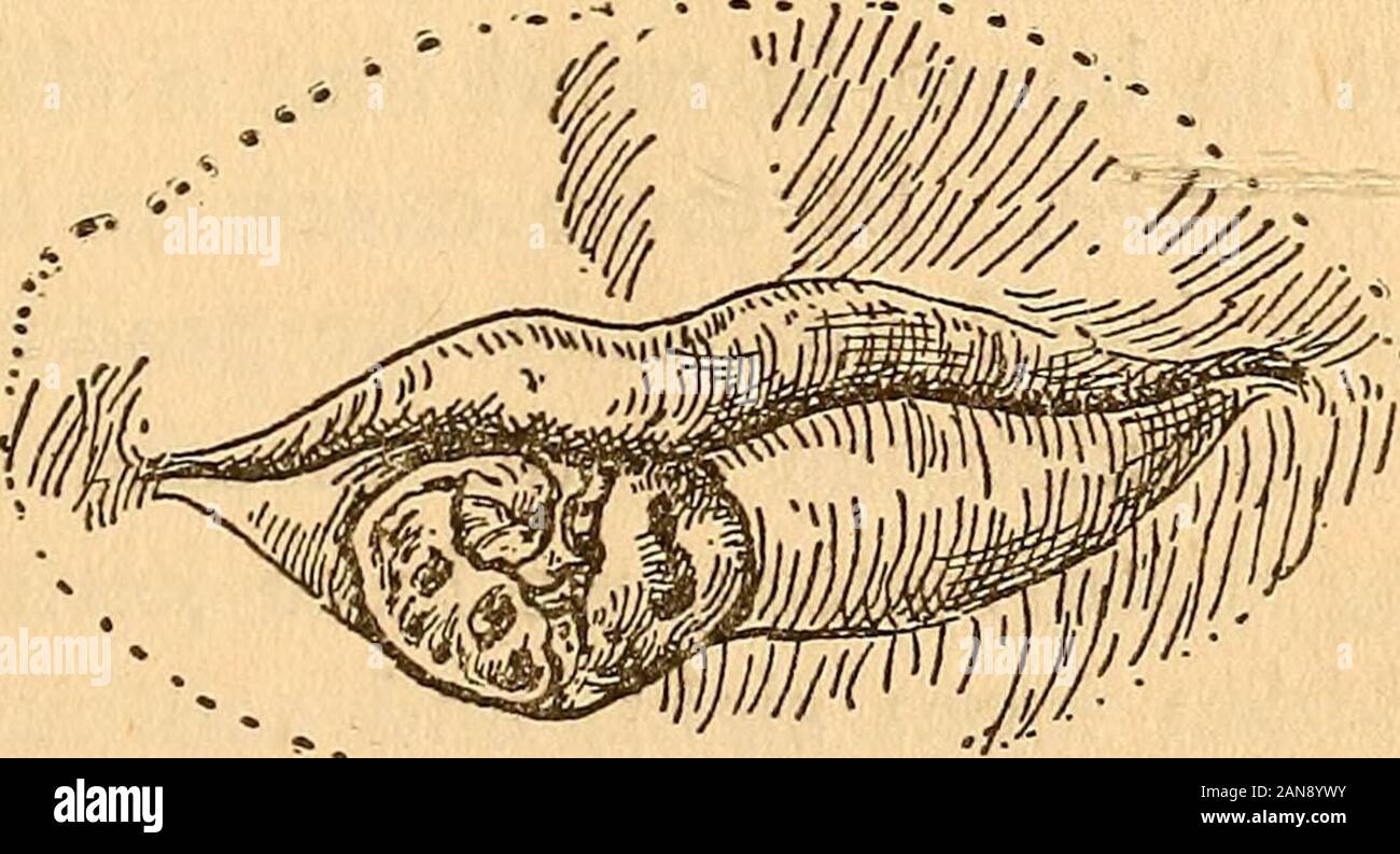 Syphilis chancre -Fotos und -Bildmaterial in hoher Auflösung – Alamy