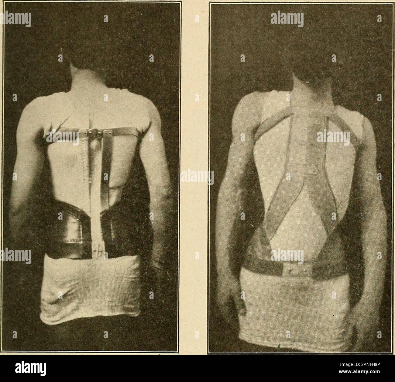 Skoliose korsett -Fotos und -Bildmaterial in hoher Auflösung – Alamy