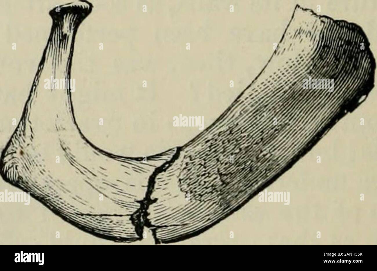 Gebrochene rippe -Fotos und -Bildmaterial in hoher Auflösung – Alamy