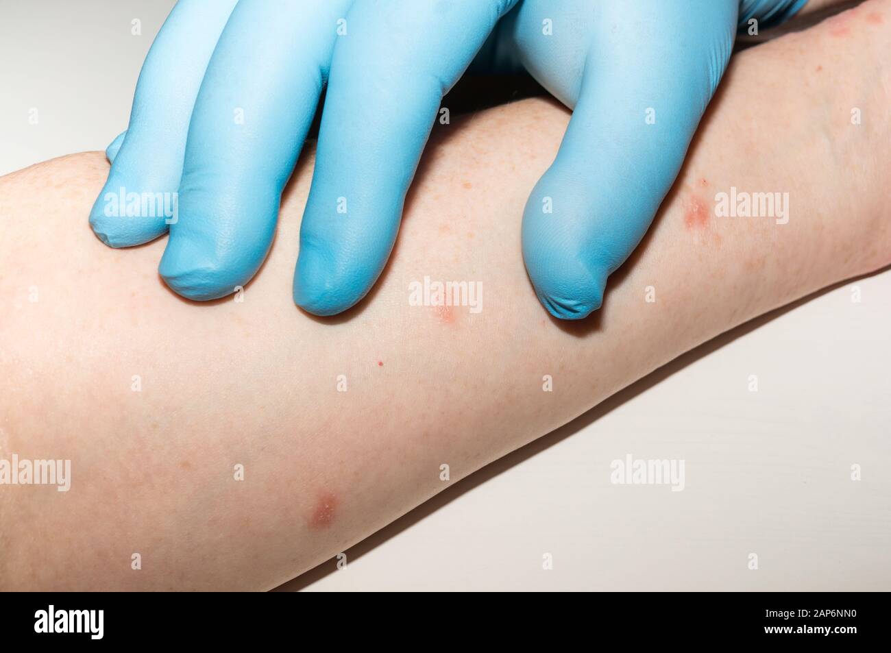Atopische dermatitis -Fotos und -Bildmaterial in hoher Auflösung – Alamy