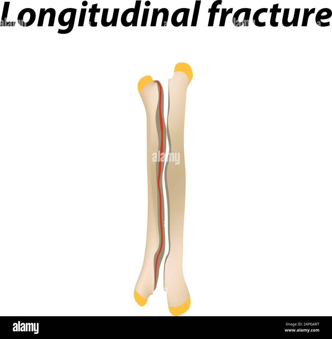Open fracture closed fracture -Fotos und -Bildmaterial in hoher ...