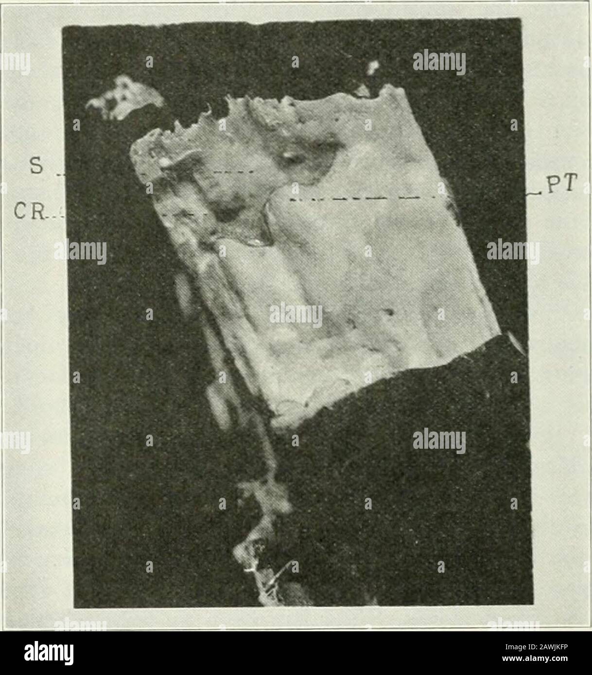 Tonsil membrane -Fotos und -Bildmaterial in hoher Auflösung – Alamy