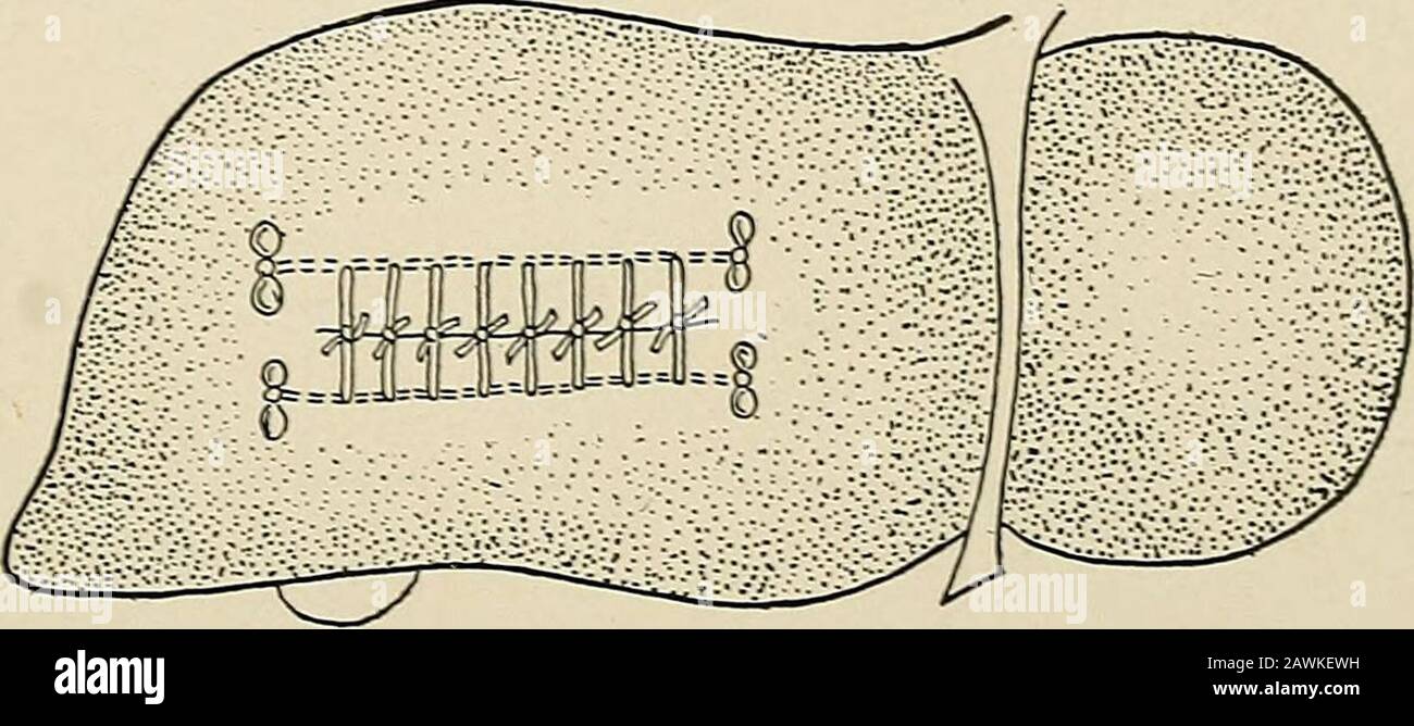 Die Praxis der Chirurgie. ^ Es gibt sonnige gutartige Tumoren der ...