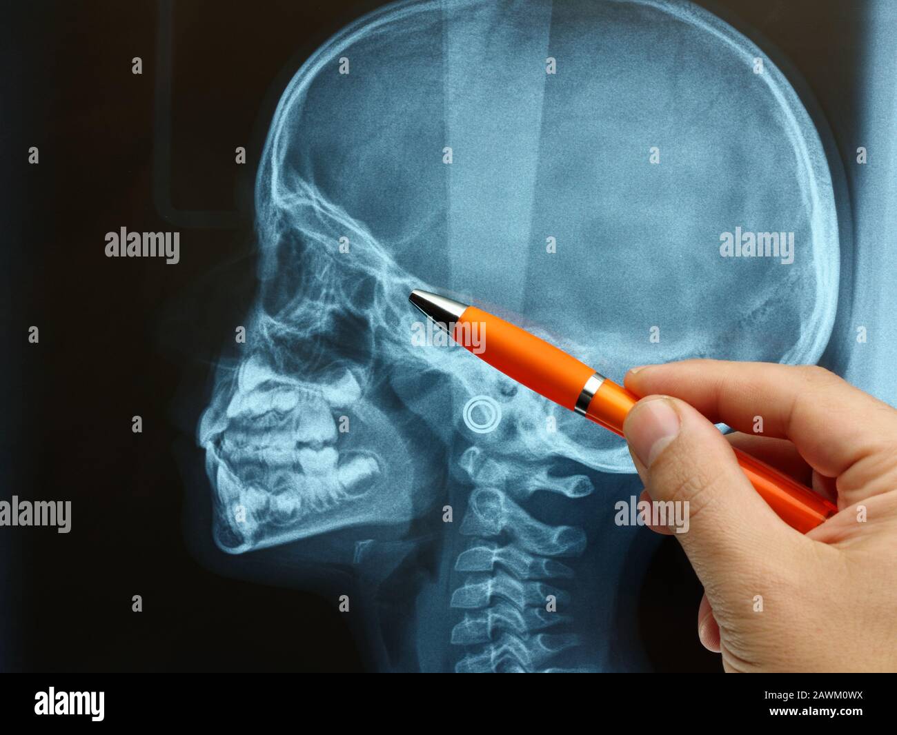 Child hand x ray -Fotos und -Bildmaterial in hoher Auflösung – Alamy