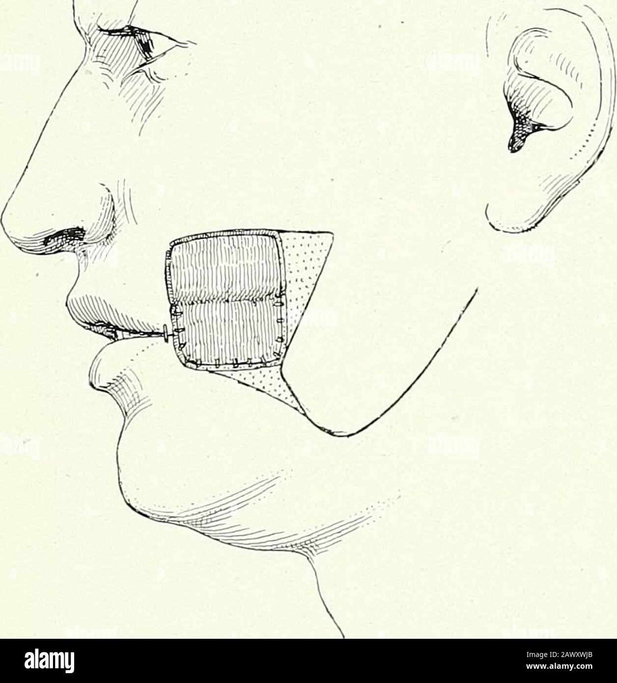 Chirurgische Therapeutika und operative Technik . Abb. 92 ...